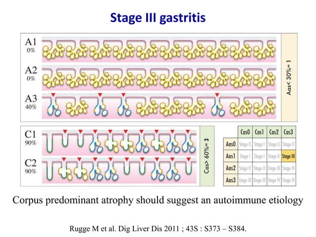 Olga staging system for diagnosis of gastritis | PPT