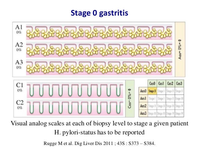 Olga staging system for diagnosis of gastritis