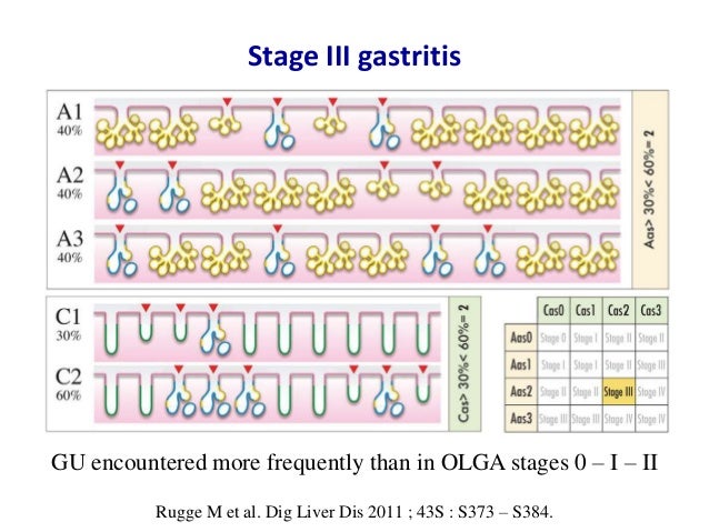 Olga staging system for diagnosis of gastritis