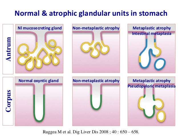 Olga staging system for diagnosis of gastritis