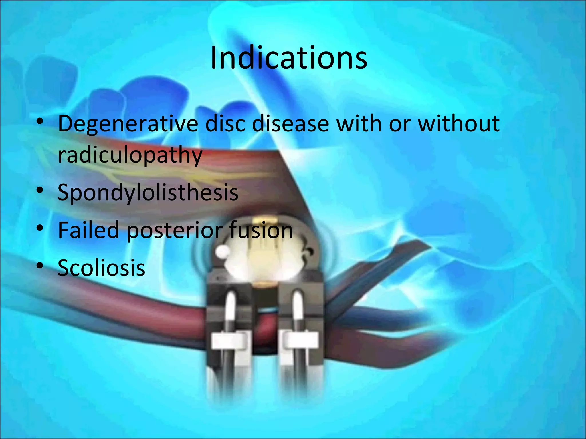 OLIF-oblique lumbar interbody fusion | PPT