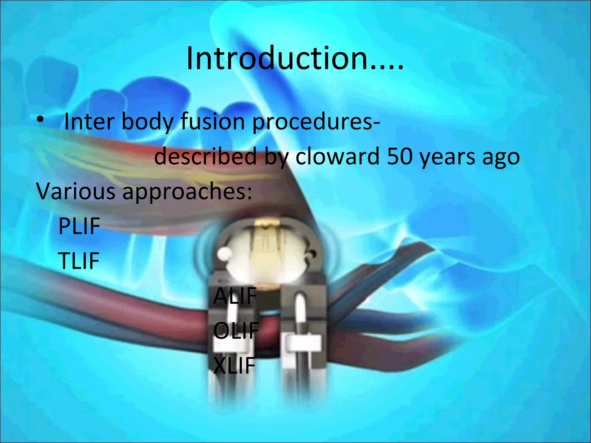 OLIF-oblique lumbar interbody fusion | PPT