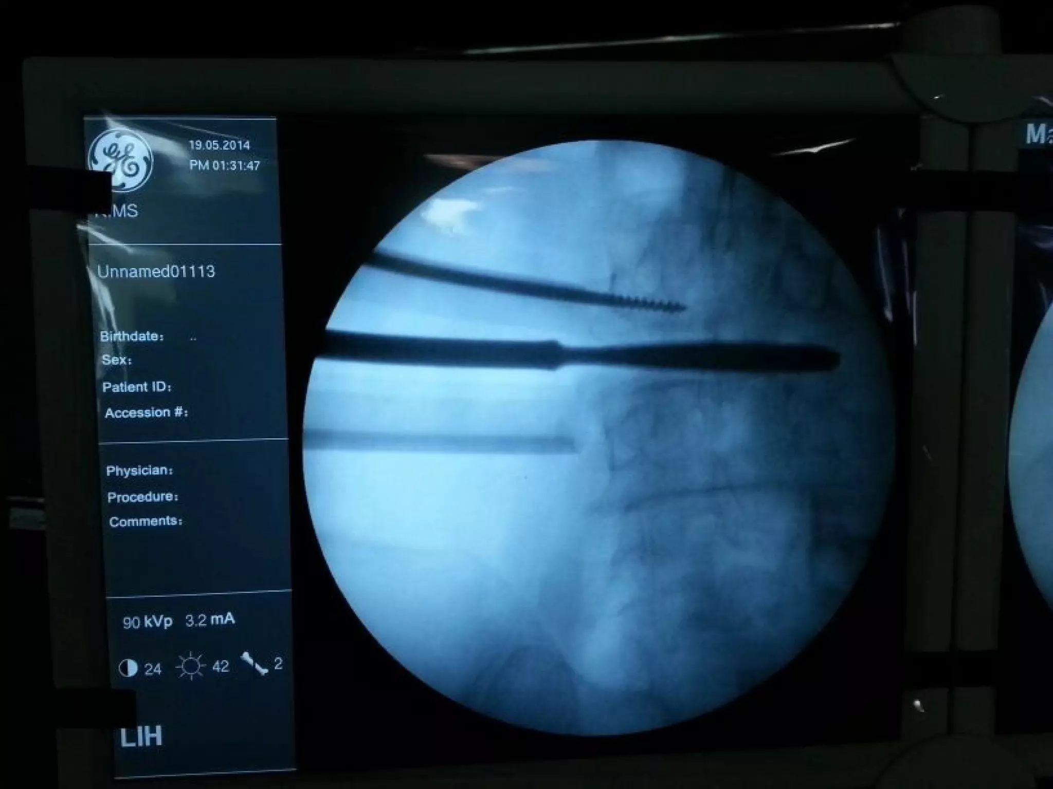 OLIF-oblique lumbar interbody fusion | PPT