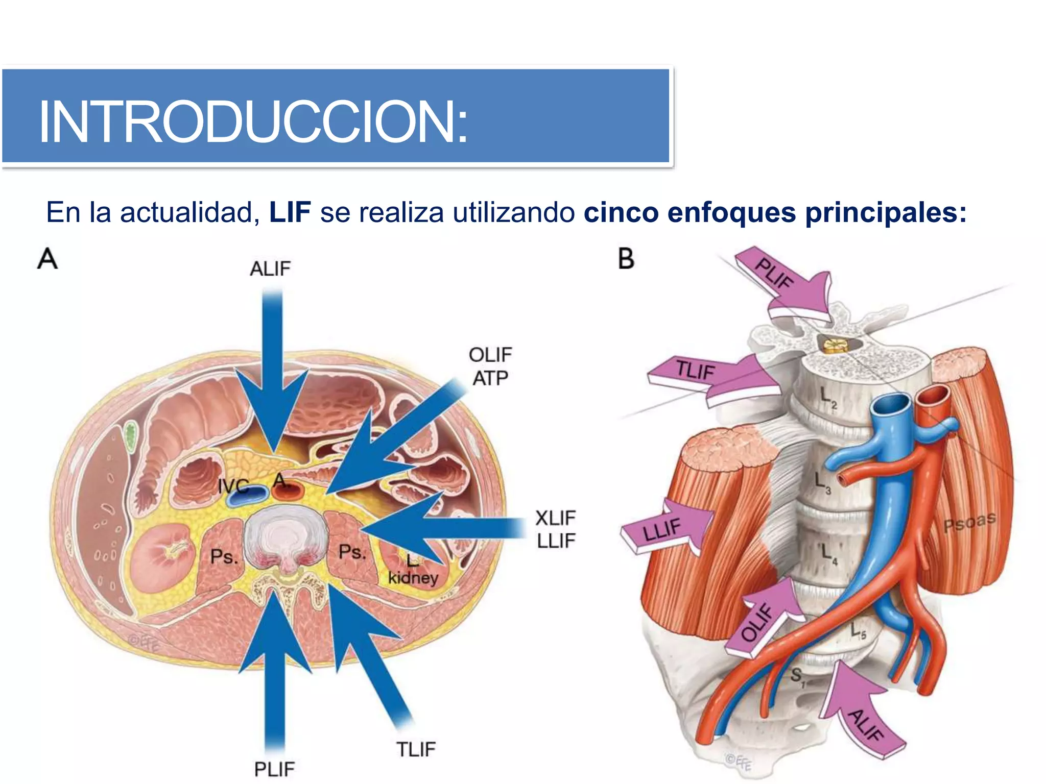 OLIF ABORDAJE QUIRURGICO.pptx