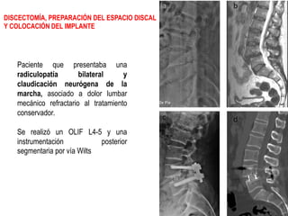 OLIF ABORDAJE QUIRURGICO.pptx