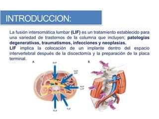 OLIF ABORDAJE QUIRURGICO.pptx