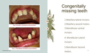 OLIGODONTIA.pptx