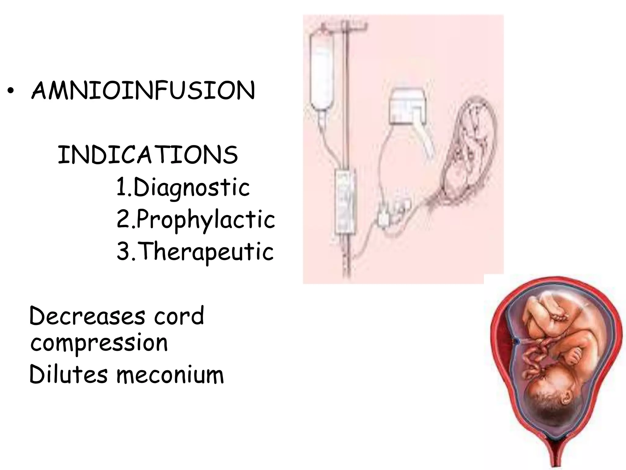 Oligohydramnios | PPTX