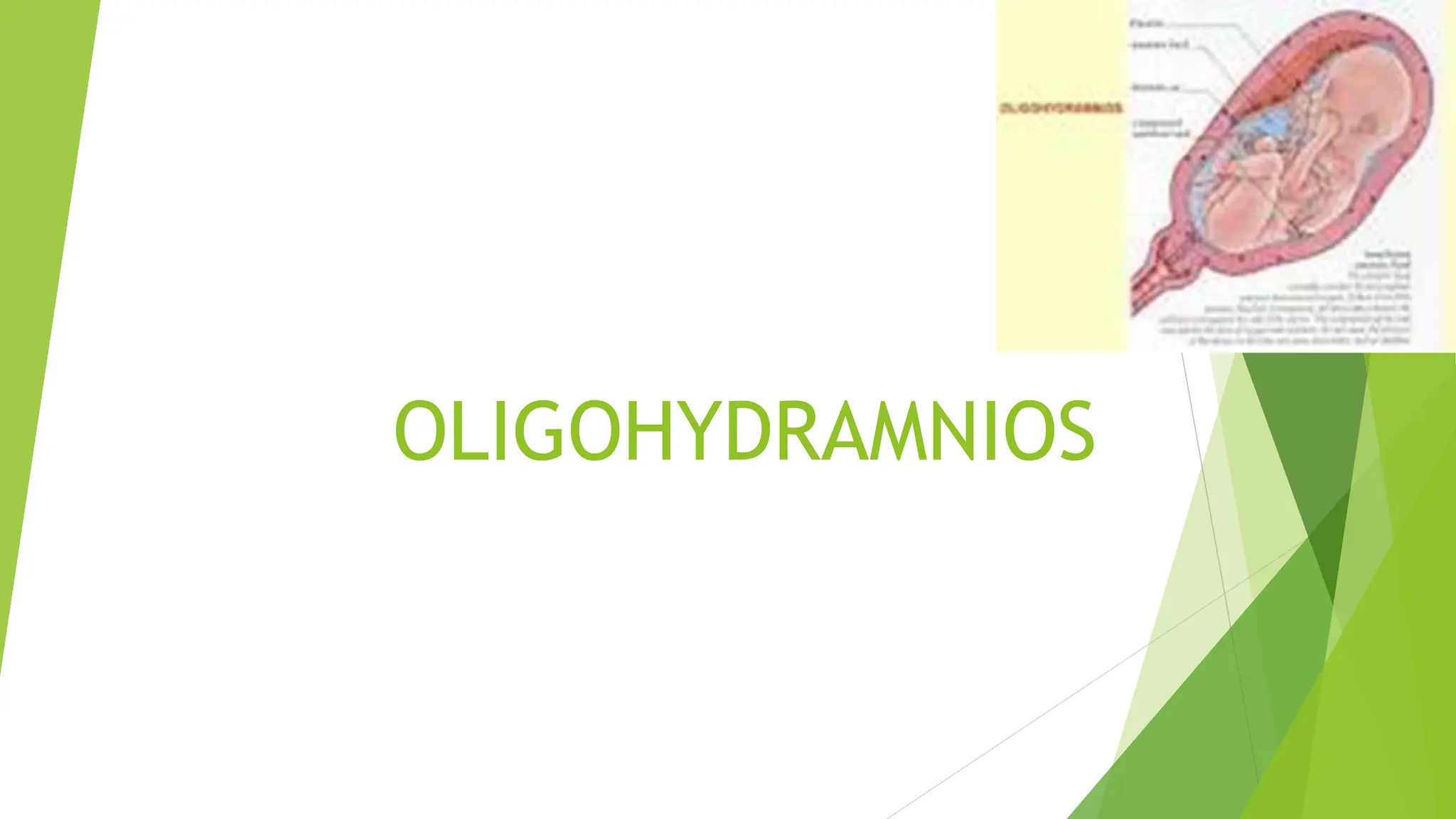 OLIGOHYDRAMNIOS.pptx