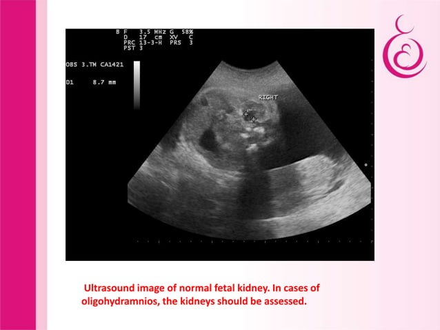 Oligohydramnios by dr alka mukherjee dr apurva mukherjee nagpur m.s ...