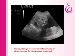 Oligohydramnios Ultrasound