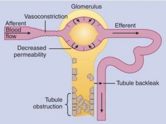 Oliguria and anuria | PPTX | Lung and Respiratory Health | Diseases and ...
