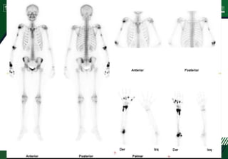 Ollier caso clinico | PPTX