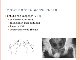Patología de la Cadera infantil | PPTX