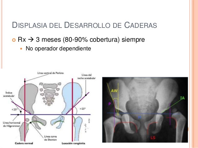 Patología de la Cadera infantil