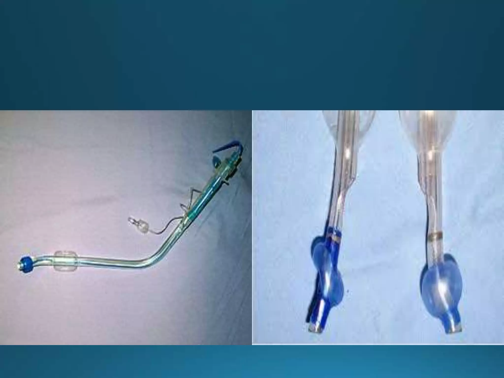 One Lung Ventilation | PPTX