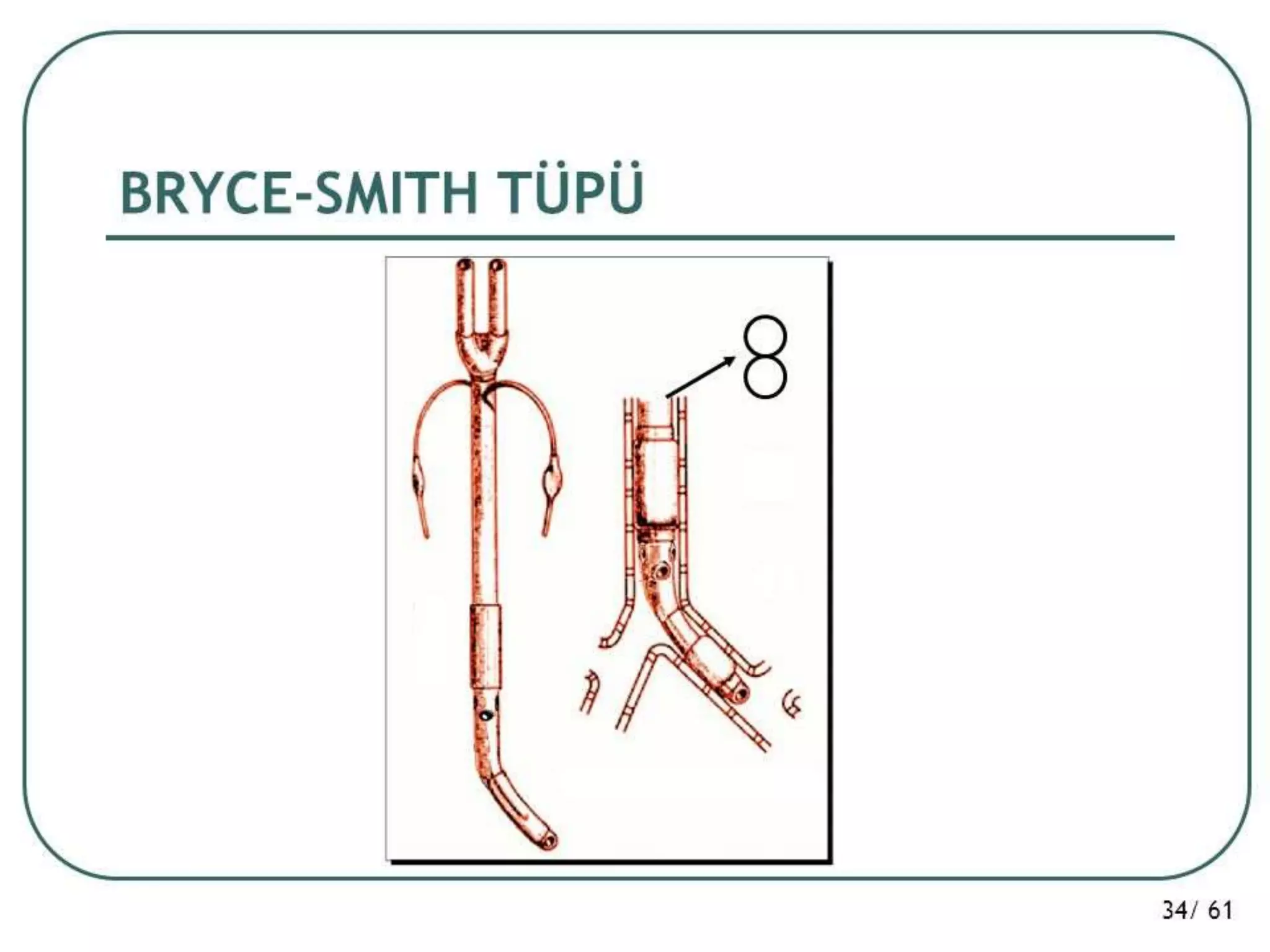 One Lung Ventilation | PPTX