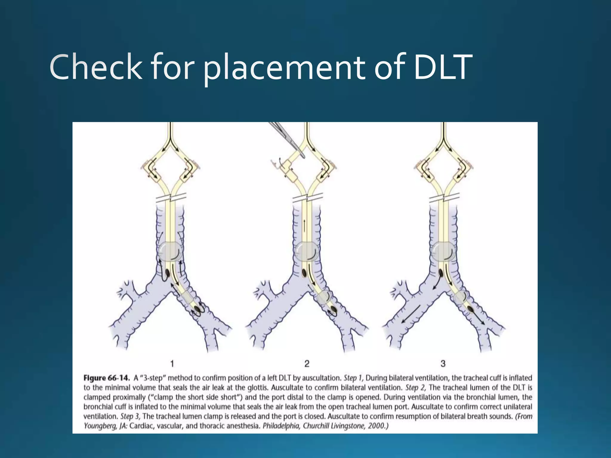 One Lung Ventilation | PPTX