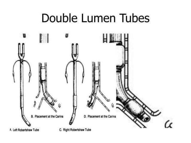 One Lung Ventilation | PPTX | Lung and Respiratory Health | Diseases ...
