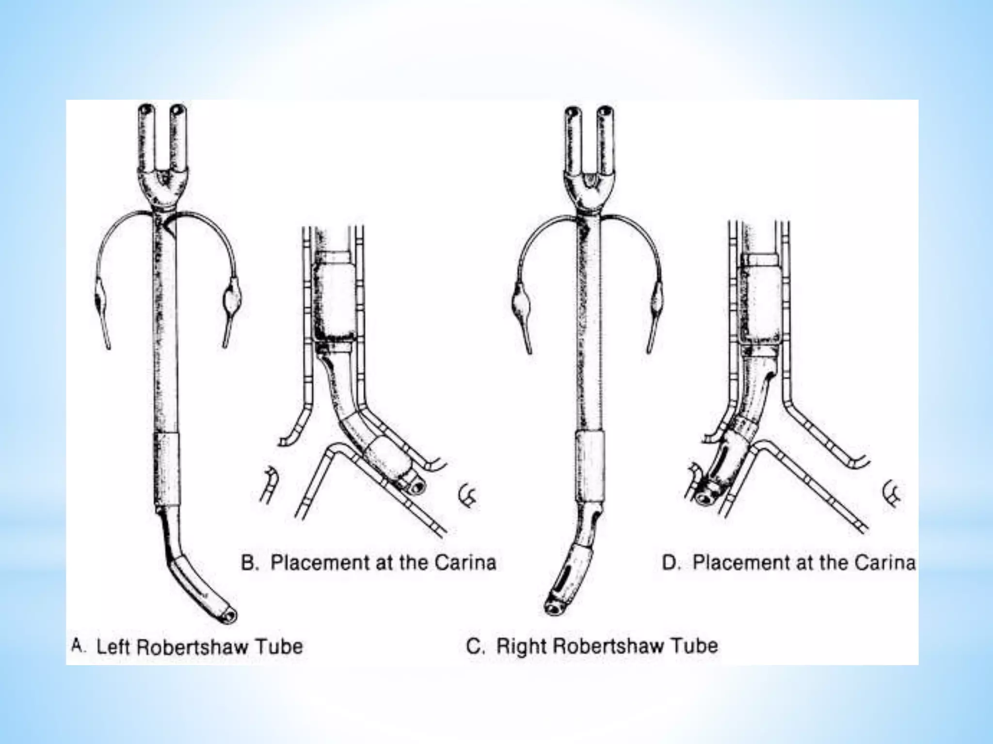 One lung ventilation in children | PPTX