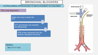 One lung ventilation in pediatric and adult patients | PPTX