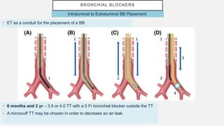 One lung ventilation in pediatric and adult patients | PPTX