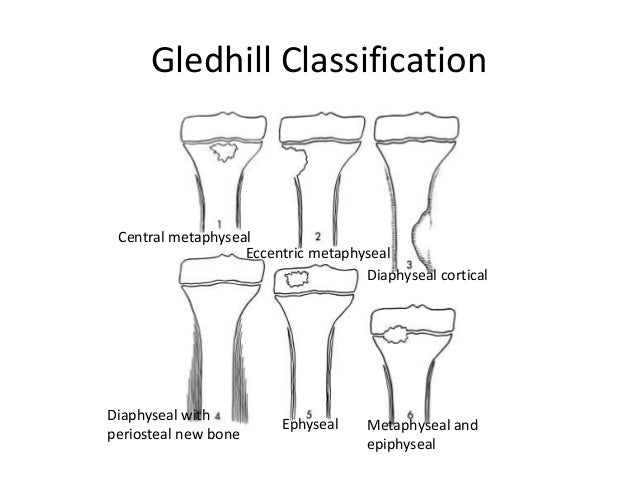 Osteomyelitis, acute, chronic,multifocal. classification, treatment