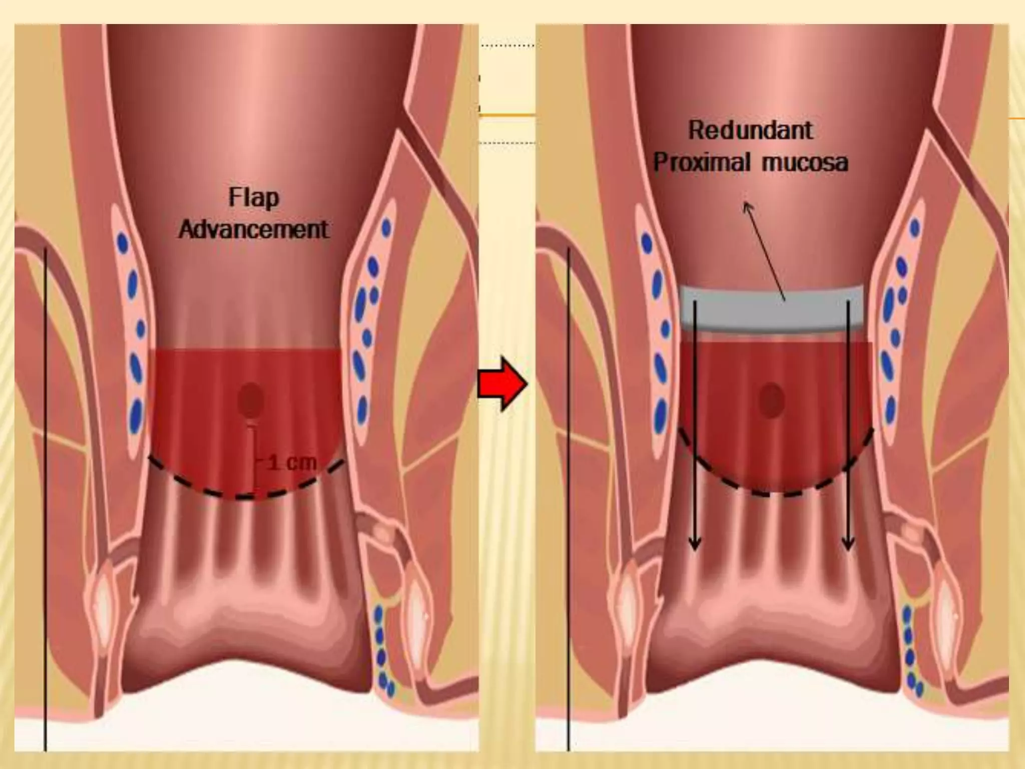Overlapping Mucosal Advancement Flap Improves Outcome.pptx