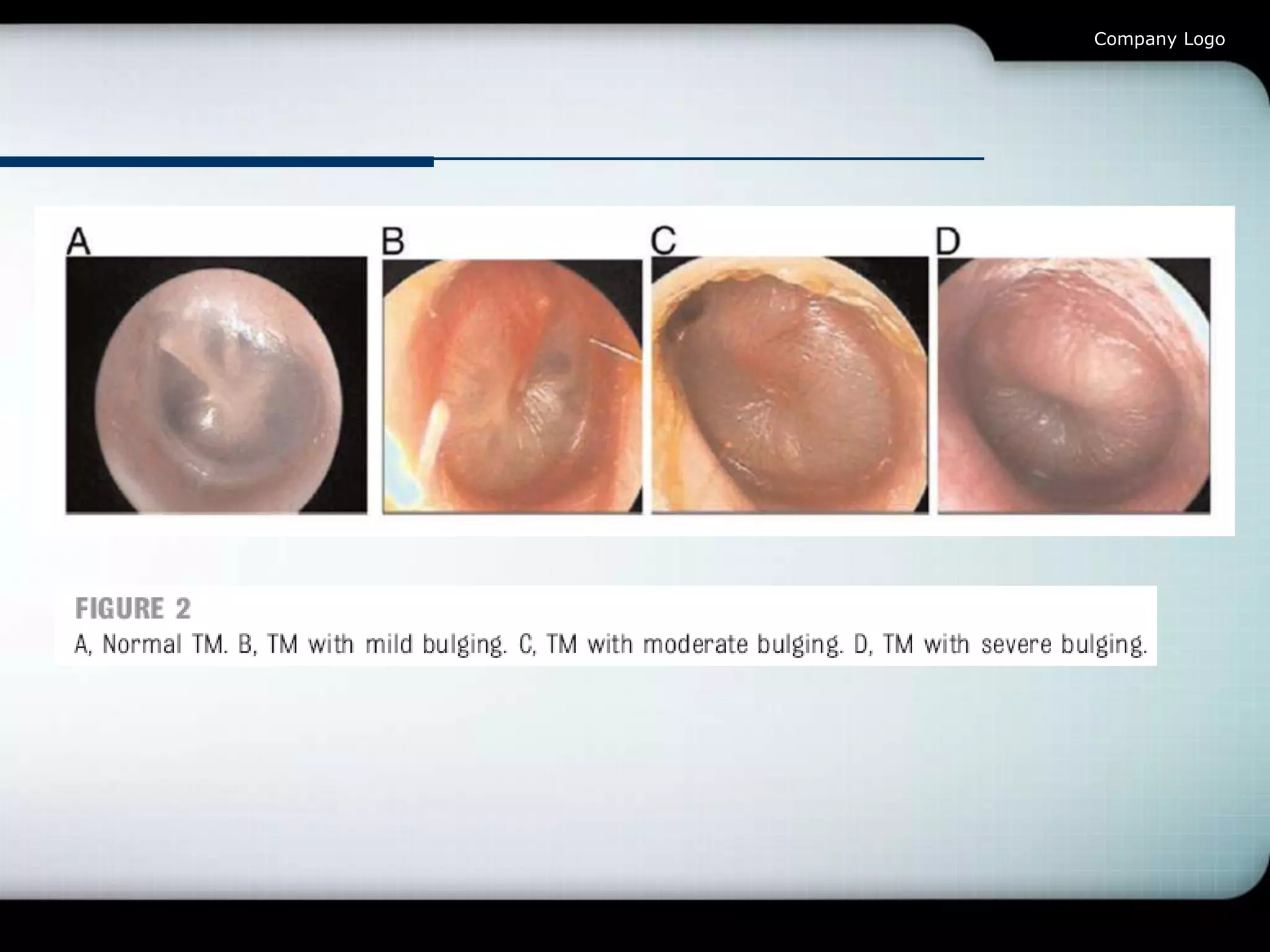 Otitis media aguda, mastoiditis, sinusitis | PPTX | Ear, Nose and ...
