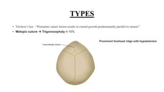 Syndromic craniosynostosis | PPTX