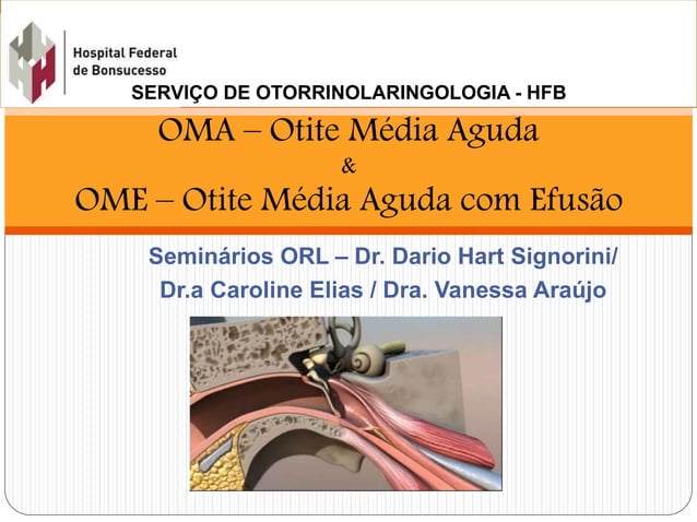 Otite Média Aguda e Otite Média Com Efusão (Serosa) | PPT