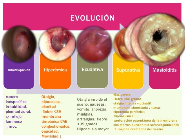 Otitis media aguda y otitis externa