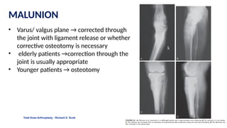 Conversion Of Osteotomy To Total Knee Arthroplasty (TKA) | PPTX