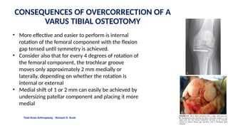 Conversion Of Osteotomy To Total Knee Arthroplasty (TKA) | PPTX