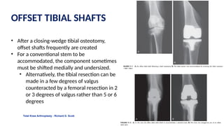 Conversion Of Osteotomy To Total Knee Arthroplasty (TKA) | PPTX