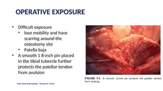 Conversion Of Osteotomy To Total Knee Arthroplasty (TKA) | PPTX