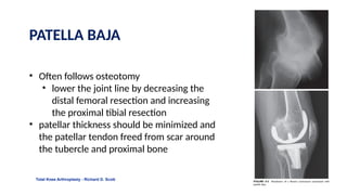 Conversion Of Osteotomy To Total Knee Arthroplasty (TKA) | PPTX