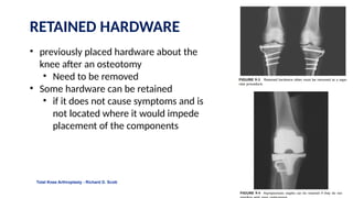 Conversion Of Osteotomy To Total Knee Arthroplasty (TKA) | PPTX