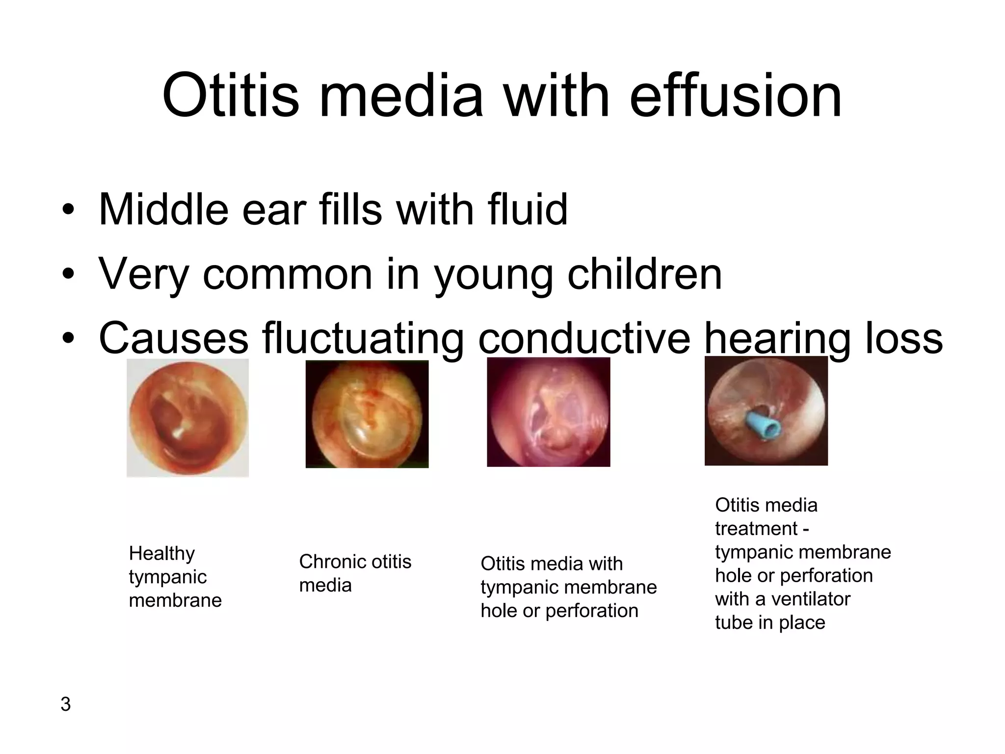 Otitis media with effusion: an illustration of ascertainment bias | PPTX