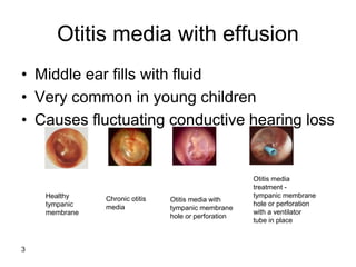 Otitis media with effusion: an illustration of ascertainment bias | PPTX