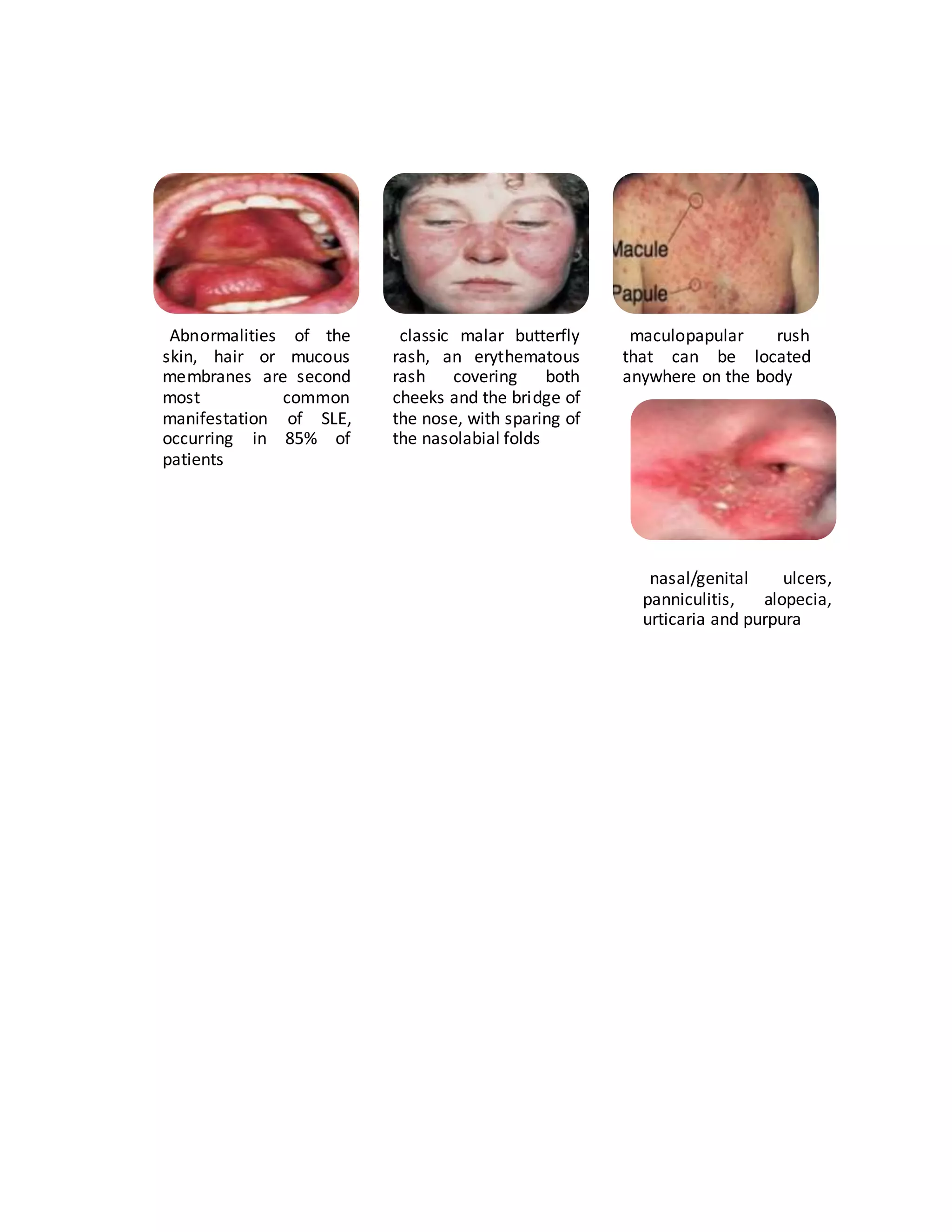 dental Management of Systemic Lupus Erythematous & Scleroderma | DOCX