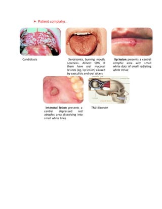 dental Management of Systemic Lupus Erythematous & Scleroderma | DOCX