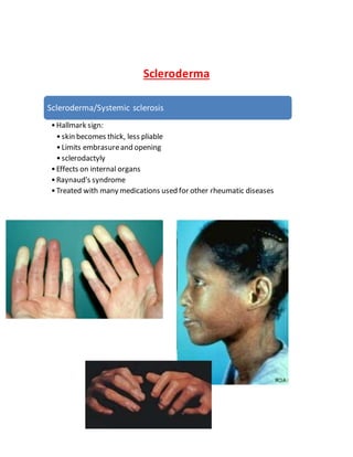 dental Management of Systemic Lupus Erythematous & Scleroderma | DOCX