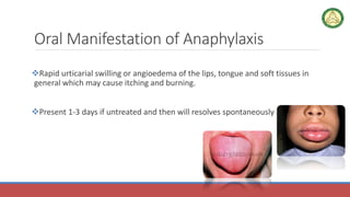 Dental Management of Anaphylaxis | PPTX