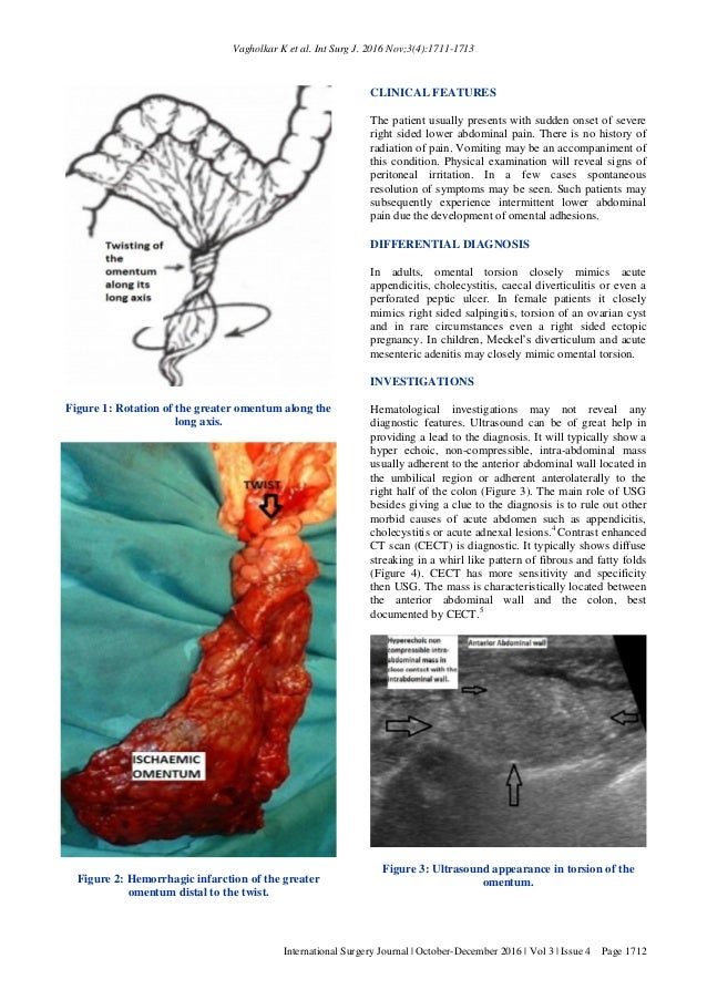 Omental Torsion A Rare Cause Of Acute Abdomen