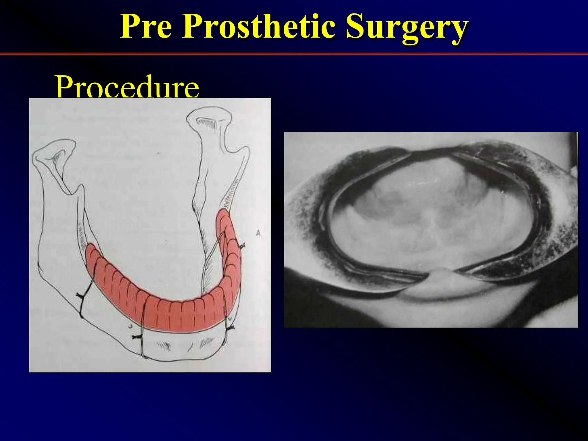 omfs- PreProsthetic Surgery for fabrication of prosthesis.ppt