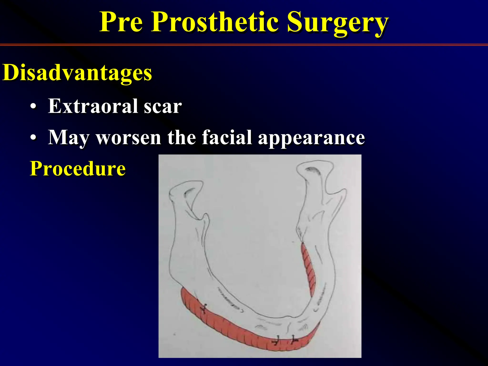 omfs- PreProsthetic Surgery for fabrication of prosthesis.ppt