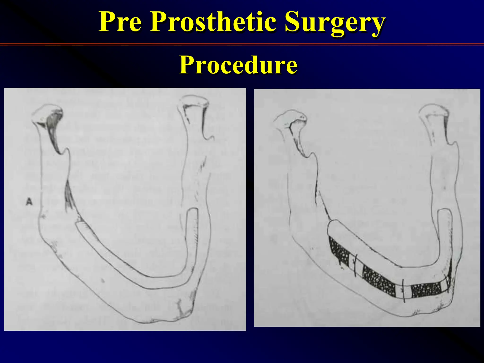 omfs- PreProsthetic Surgery for fabrication of prosthesis.ppt
