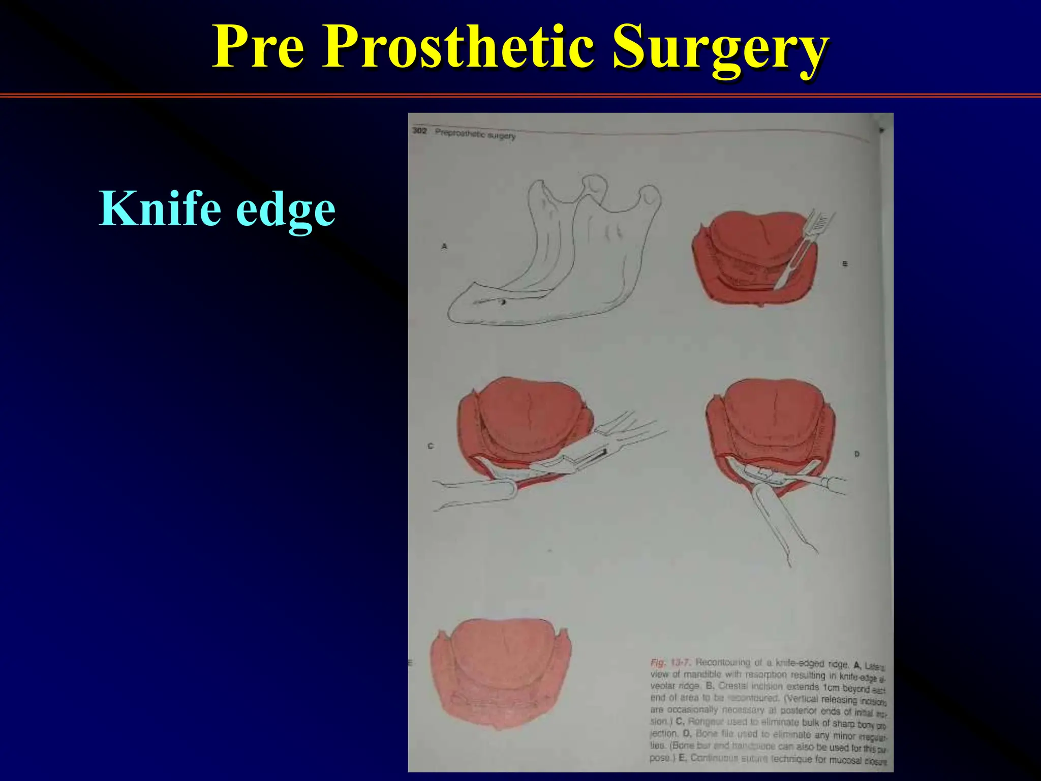 omfs- PreProsthetic Surgery for fabrication of prosthesis.ppt