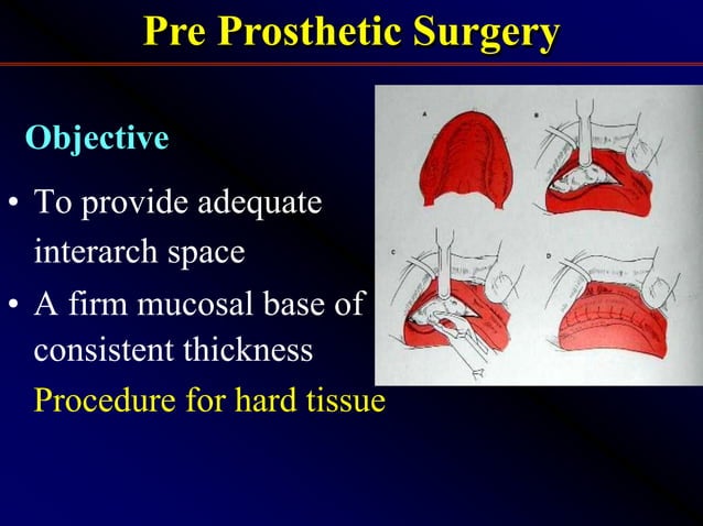 omfs- PreProsthetic Surgery for fabrication of prosthesis.ppt